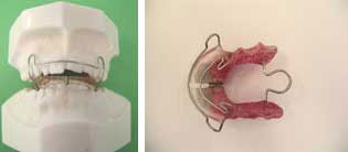 Bionator - St Charles Orthodontist | Garvey Team Orthodontics, P.C.