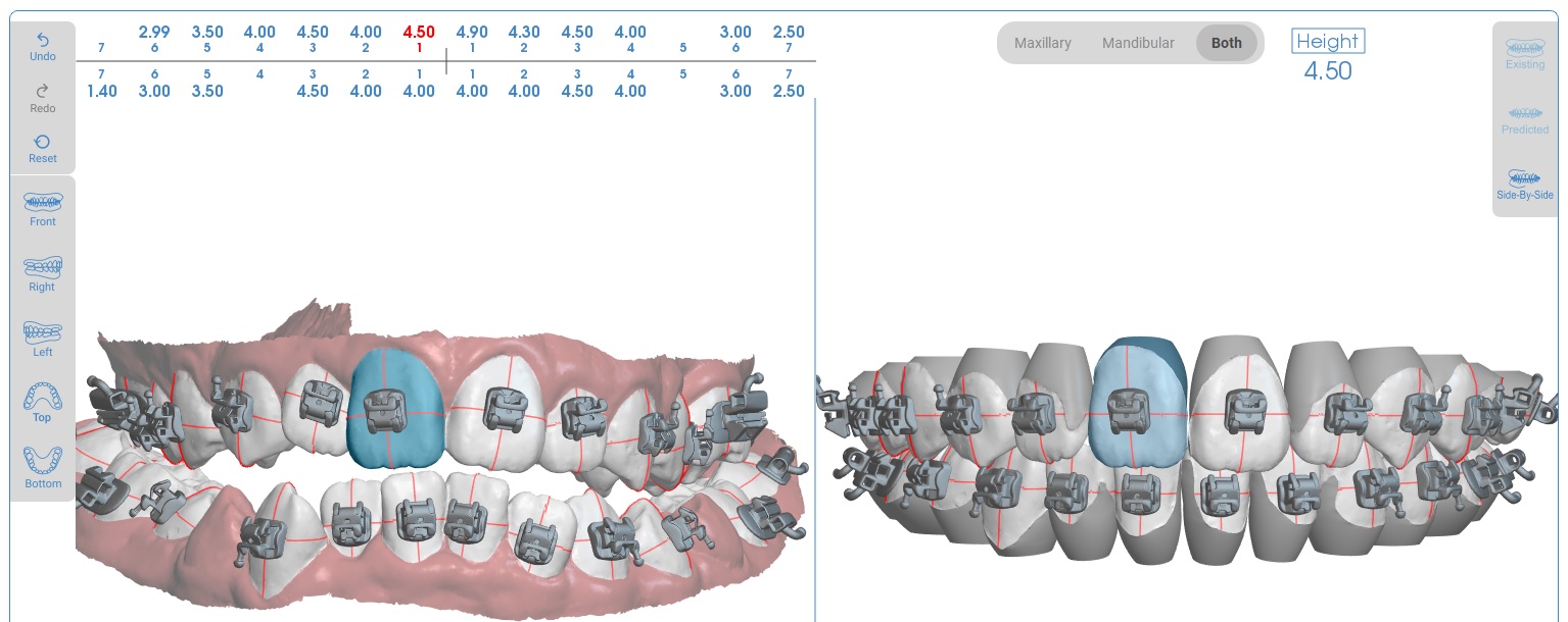 Self Ligating Braces Treatment - Chesterfield & St. Charles, MO
